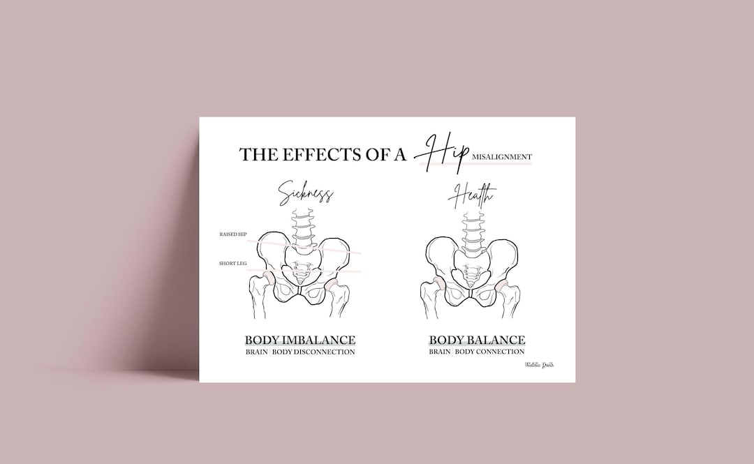 Hip Misalignment Print // Body Imbalance Print // Spinal Nerve Chart ...