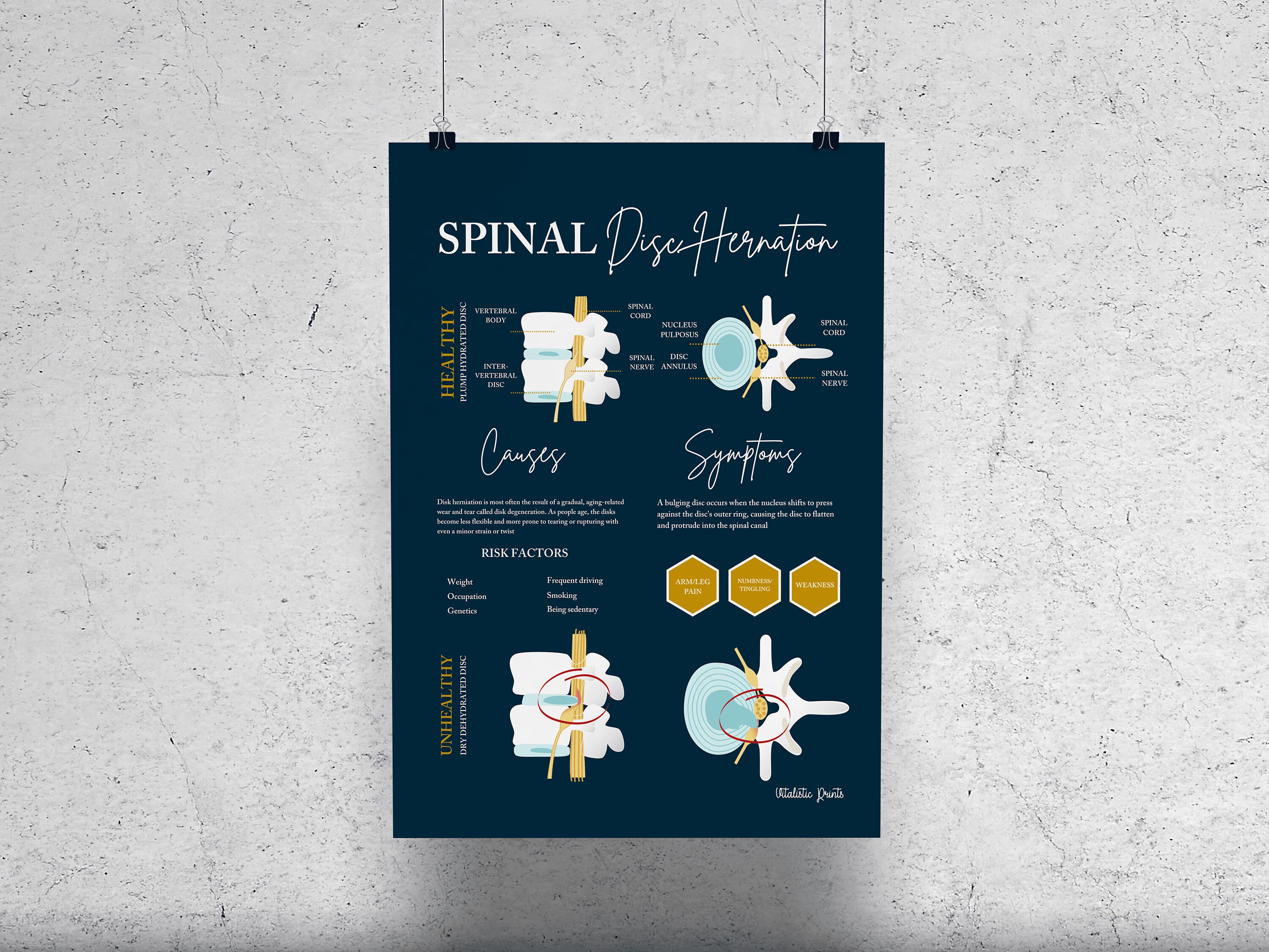 Spinal Disc Herniation Print // Intervertebral Disc Print ...
