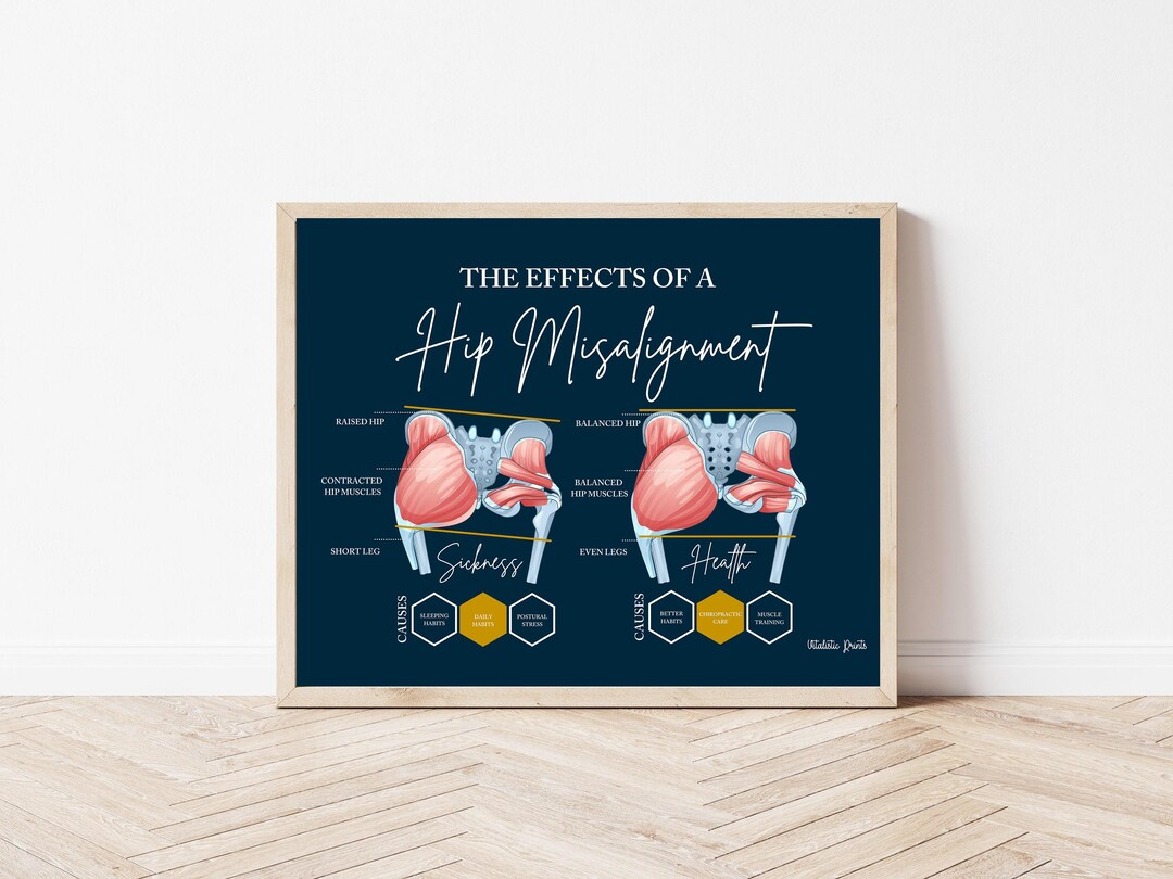 Hip Misalignment Print // Spinal Nerve Chart // Chiropractic ...