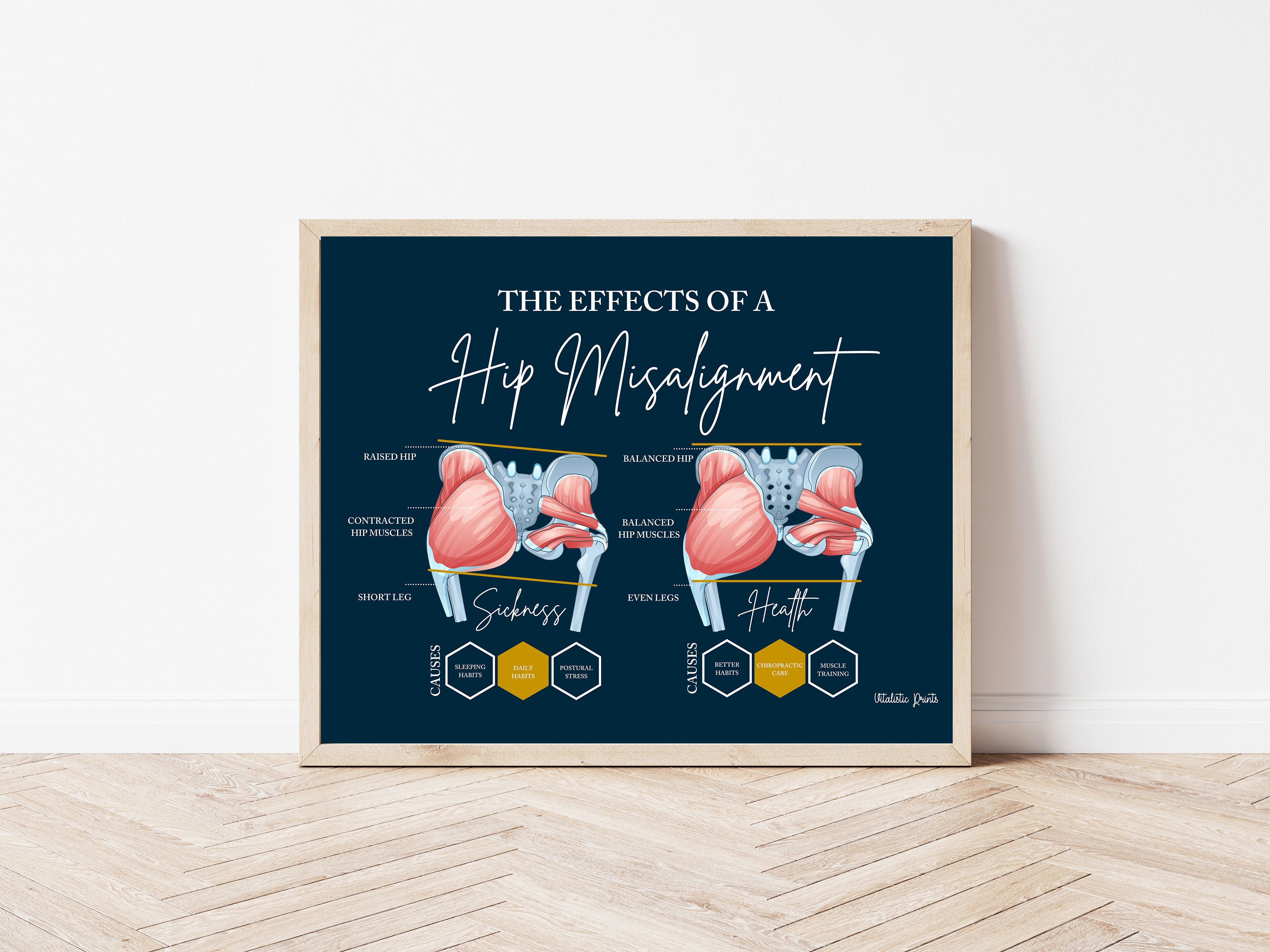 Hip Misalignment Print // Spinal Nerve Chart // Chiropractic ...