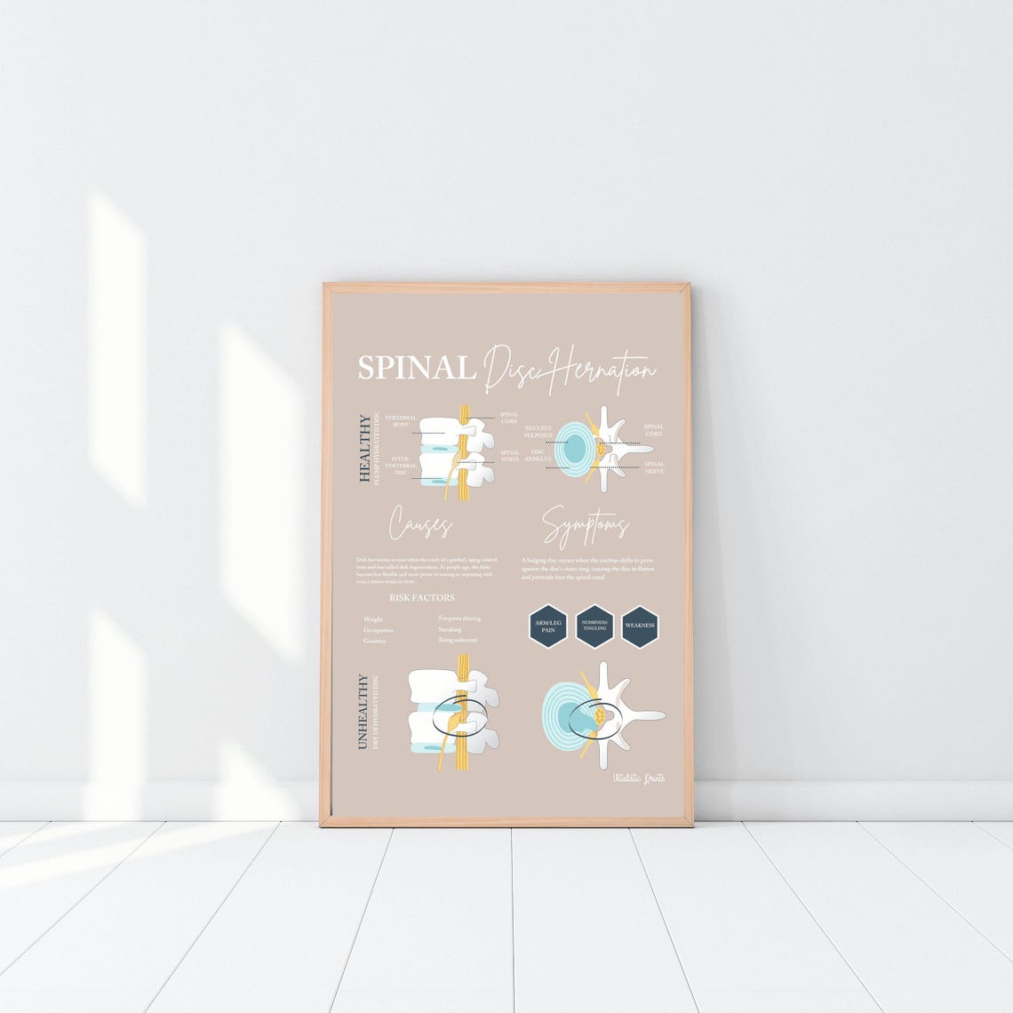 Spinal Disc Herniation Print // Intervertebral Disc Print ...