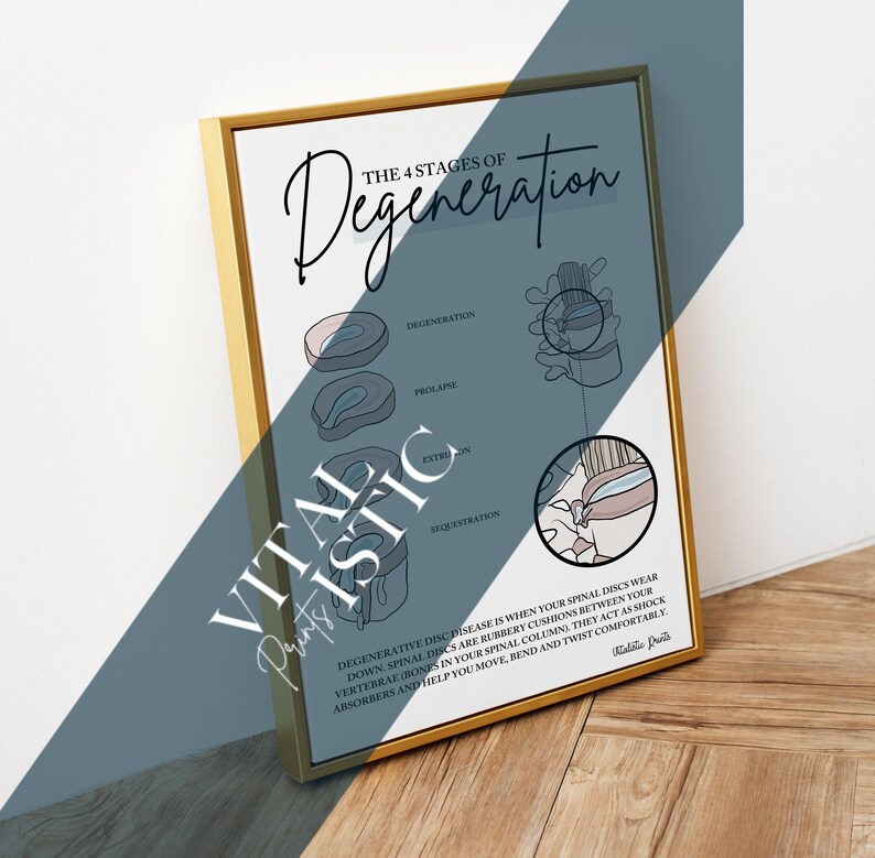 The 4 Stages of Degeneration Print // Spinal Nerve Chart ...