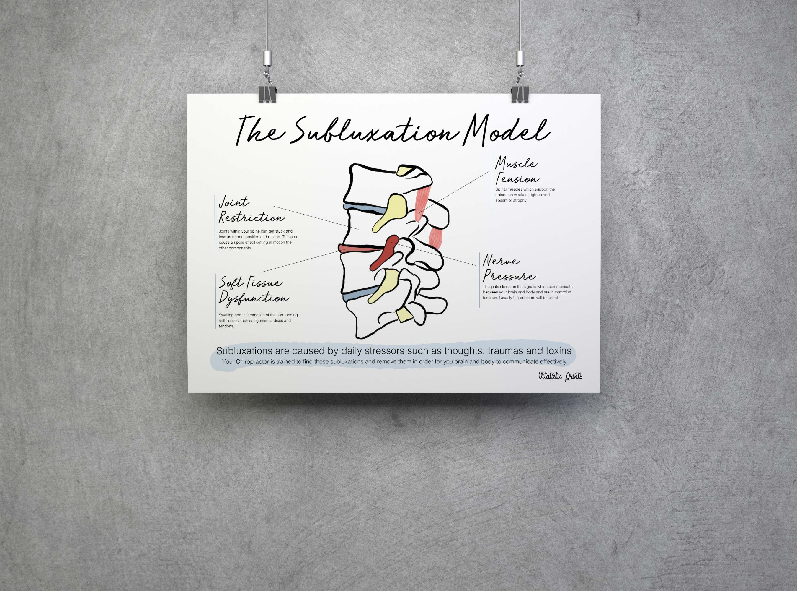 Subluxation Model // Chiropractic // Subluxation Complex // Symptoms ...