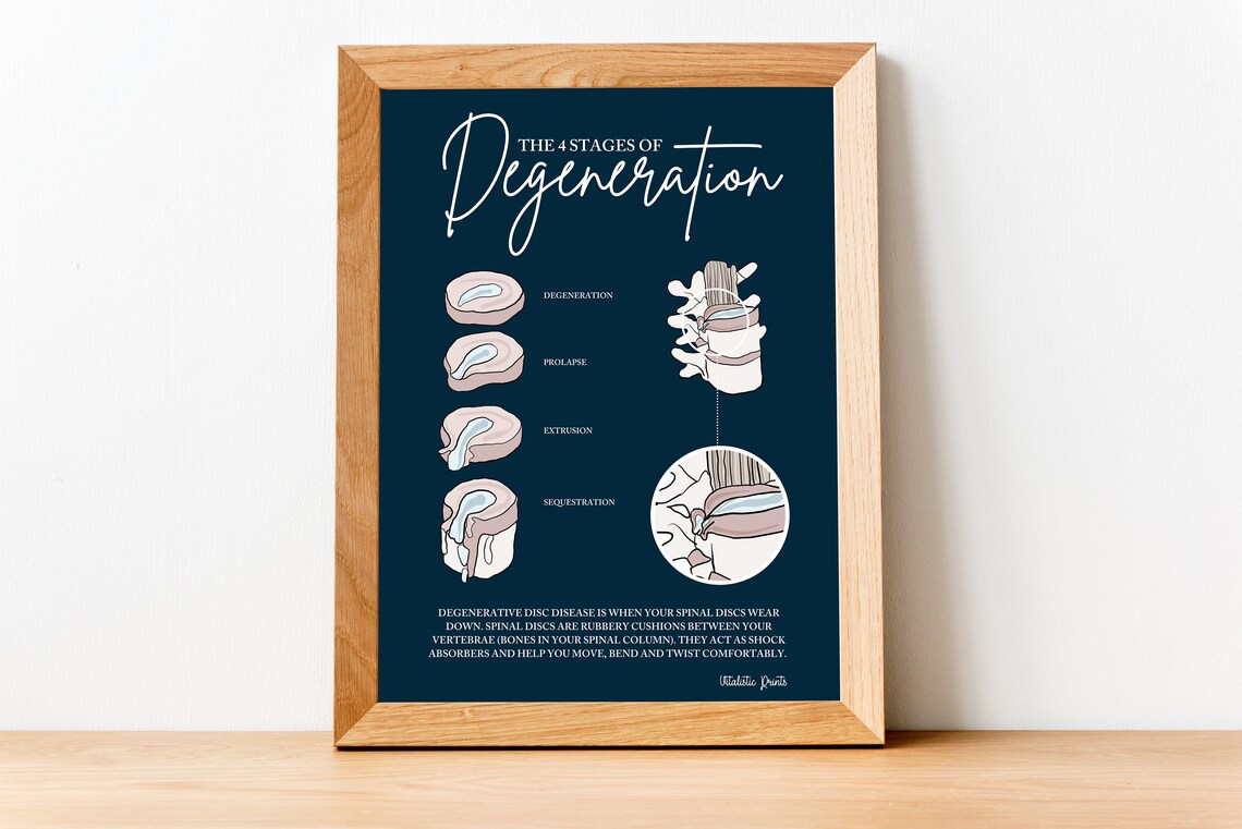 The 4 Stages of Degeneration Print // Spinal Nerve Chart ...