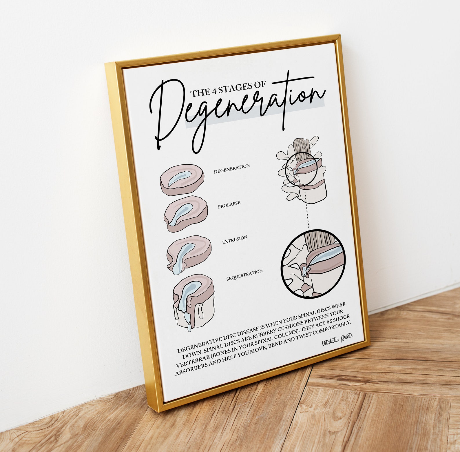 The 4 Stages of Degeneration Print // Spinal Nerve Chart ...