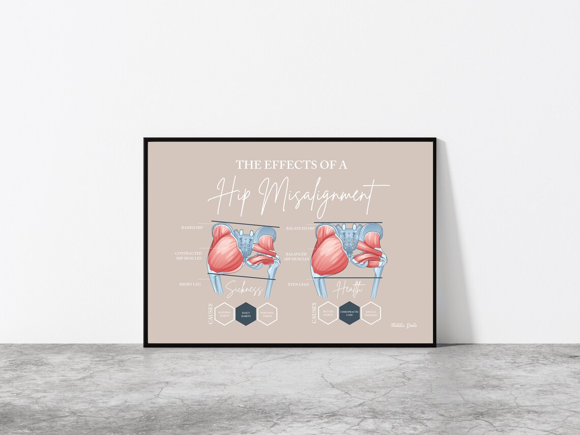 Hip Misalignment Print // Spinal Nerve Chart // Chiropractic ...