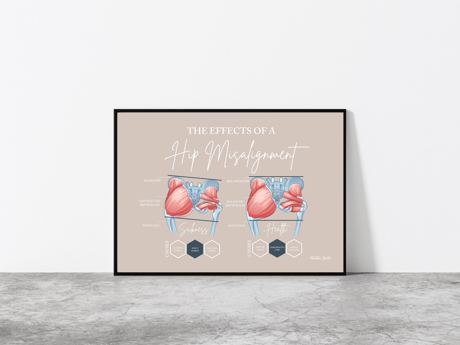 Hip Misalignment Print // Spinal Nerve Chart // Chiropractic ...