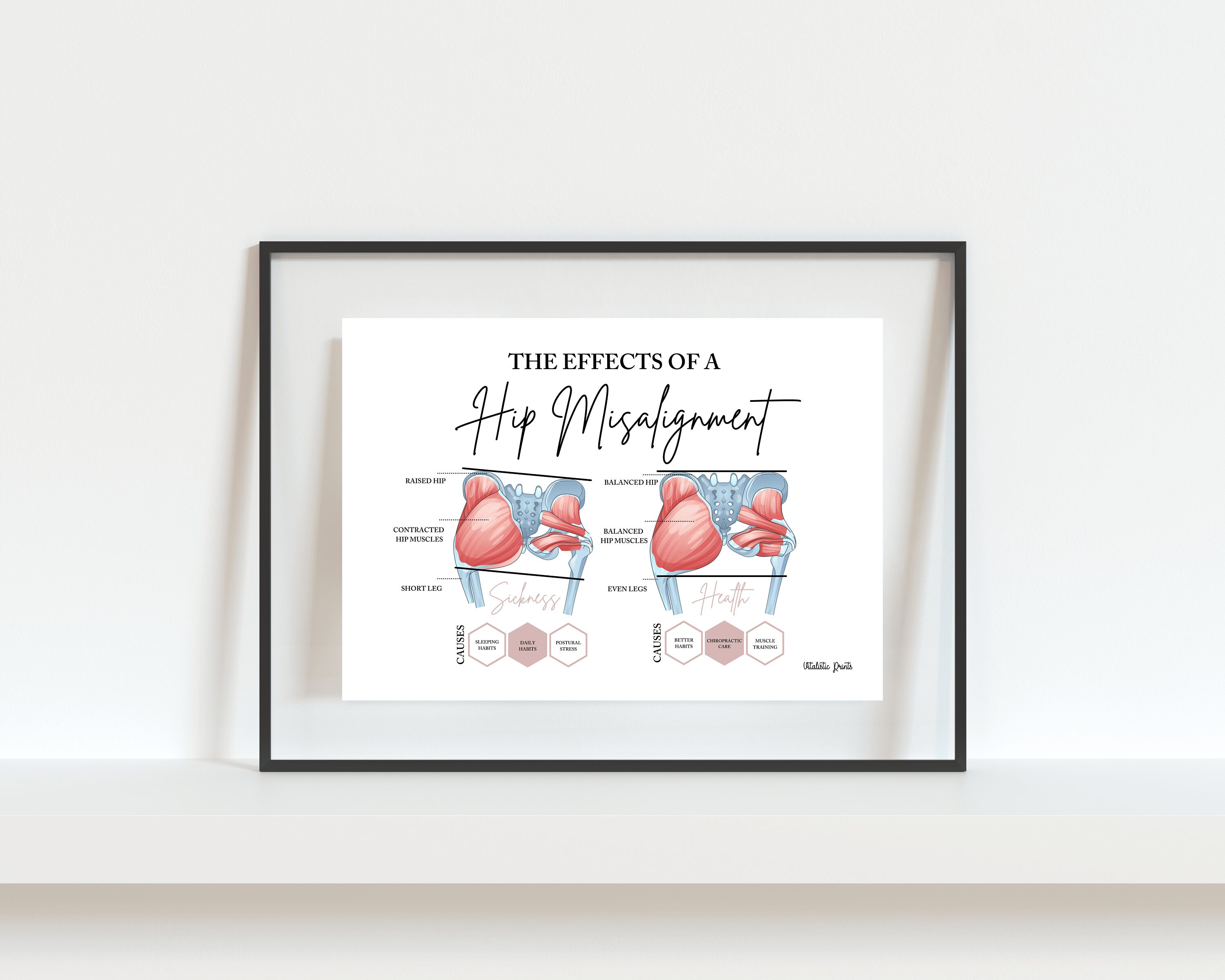 Hip Misalignment Print // Spinal Nerve Chart // Chiropractic ...