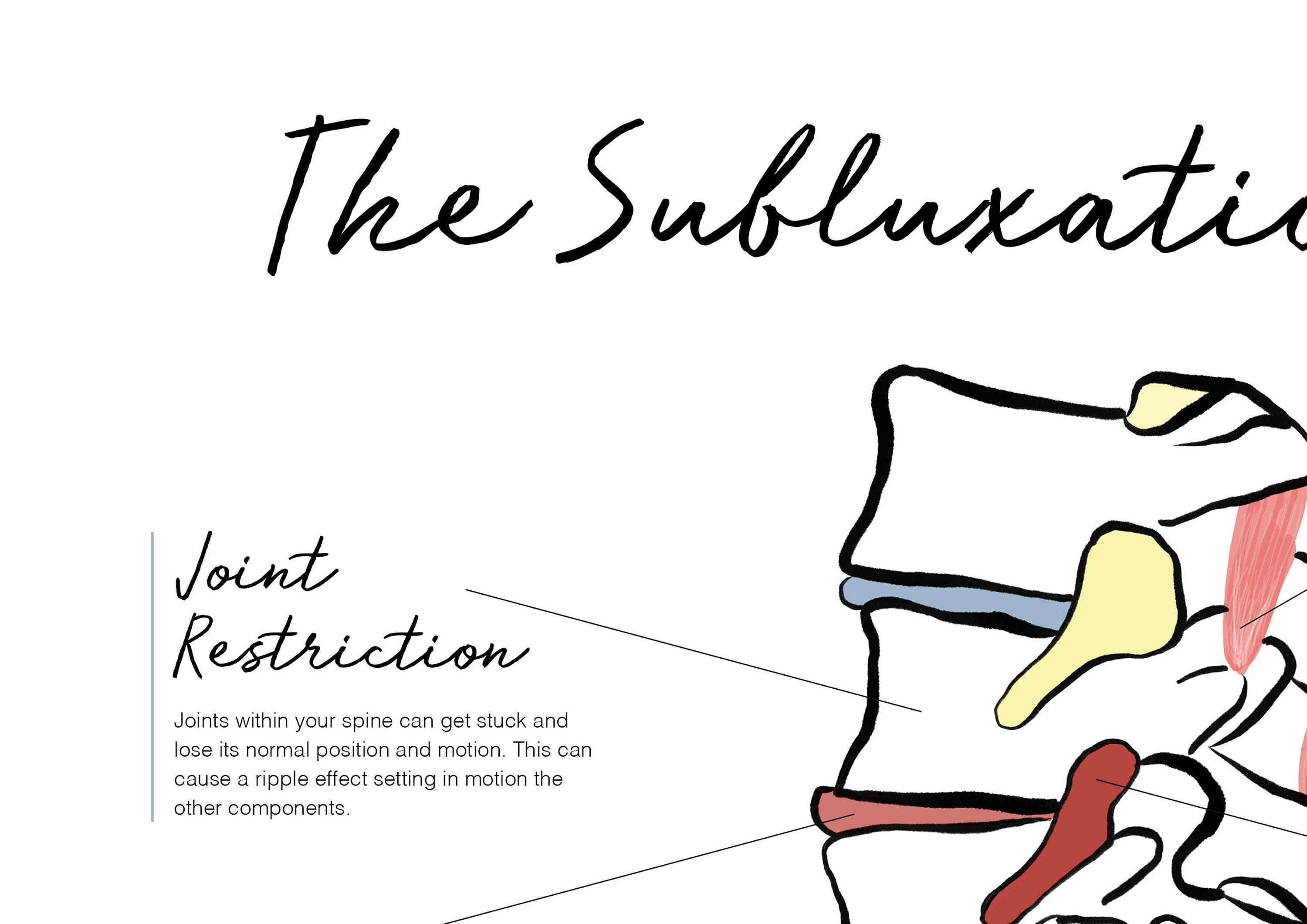 Subluxation Model // Chiropractic // Subluxation Complex // Symptoms ...
