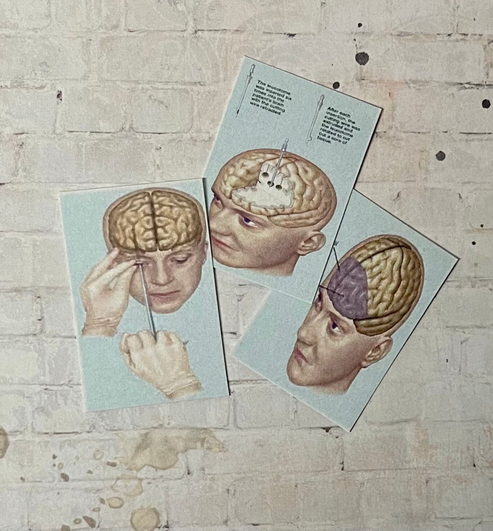 3 Pc Asylum Lobotomy Medical Charts/posters This is NOT Life - Etsy