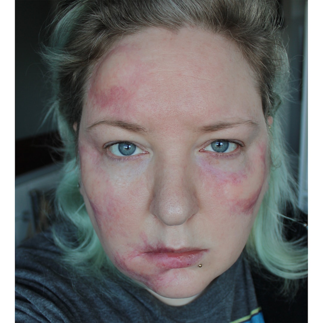 Medium Swellings Prosthetic Set // Encapsulated Silicone // Injury ...