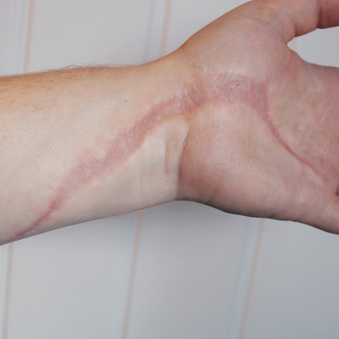Large Scar Prosthetic // Encapsulated Silicone // Injury Wound Scarring ...