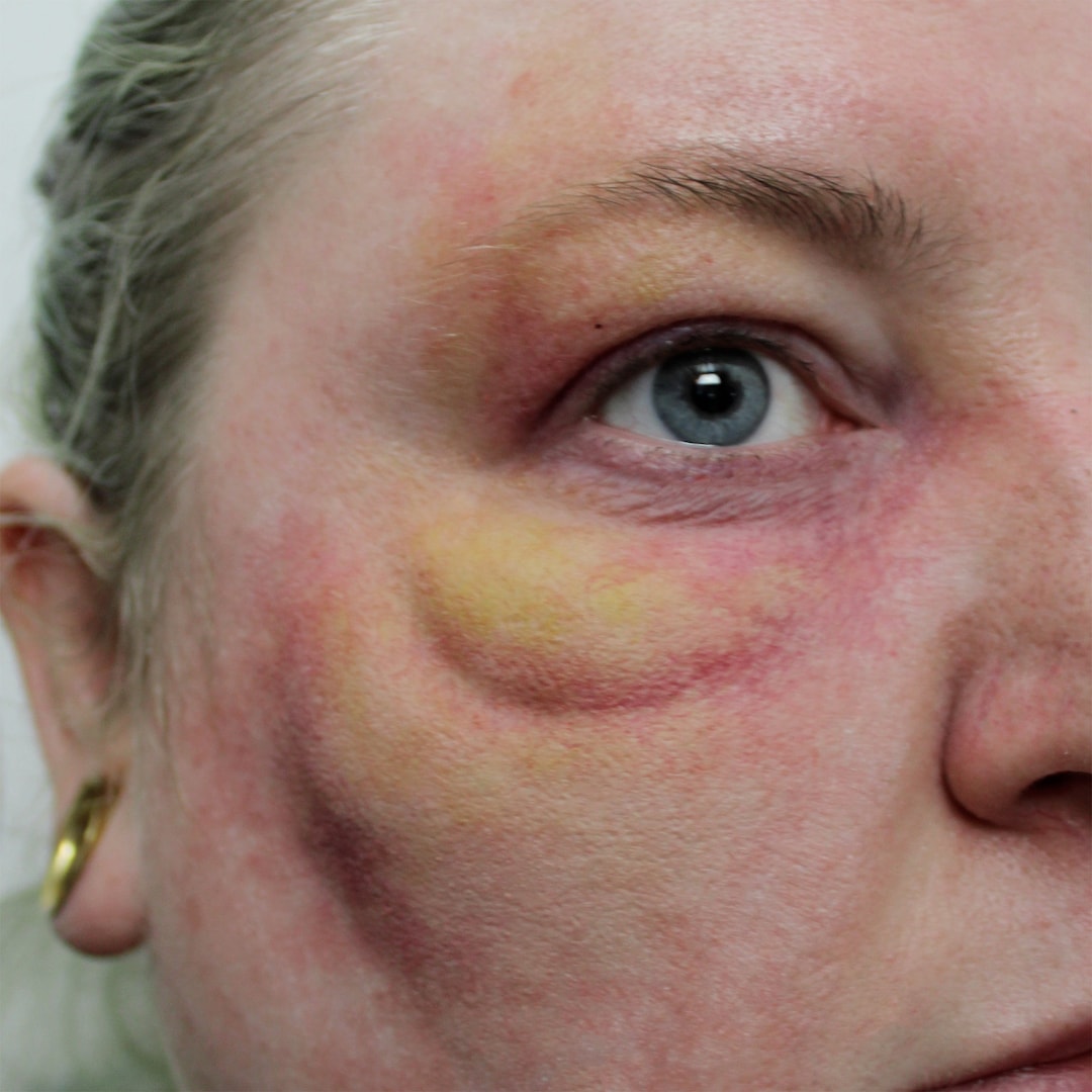 Swollen Eye and Cheek Prosthetic Right Side // Encapsulated - Etsy UK