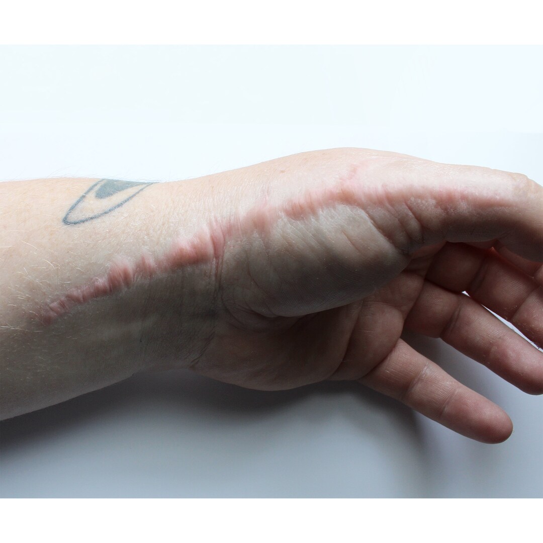 Keloid Scar 3 Silicone Prosthetic // Encapsulated Silicone Appliance ...