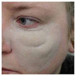 Swollen Eye and Cheek Prosthetic Left Side // Encapsulated Silicone ...