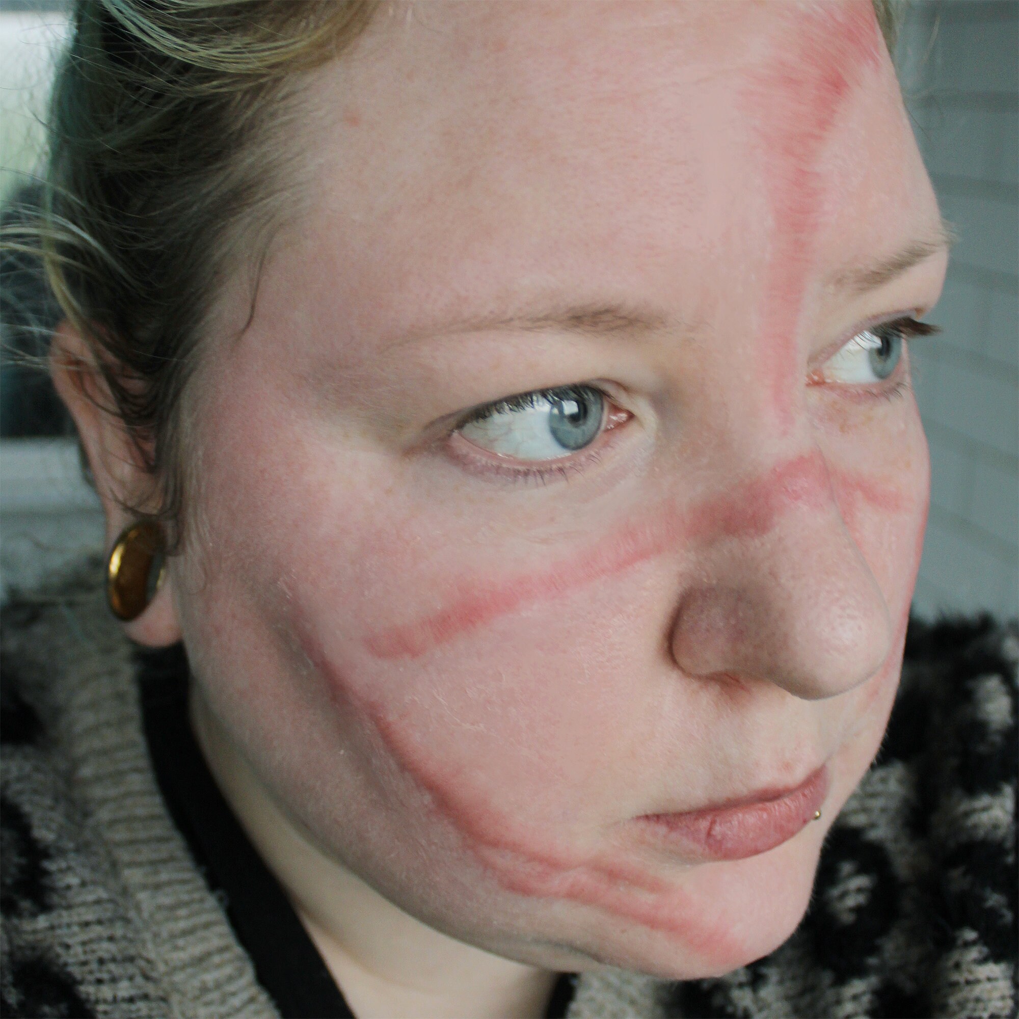 Set of Medium Healed Keloid Scar Prosthetics // Encapsulated - Etsy UK