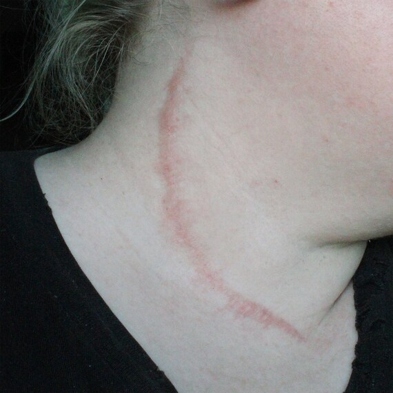 Neck Keloid Skin