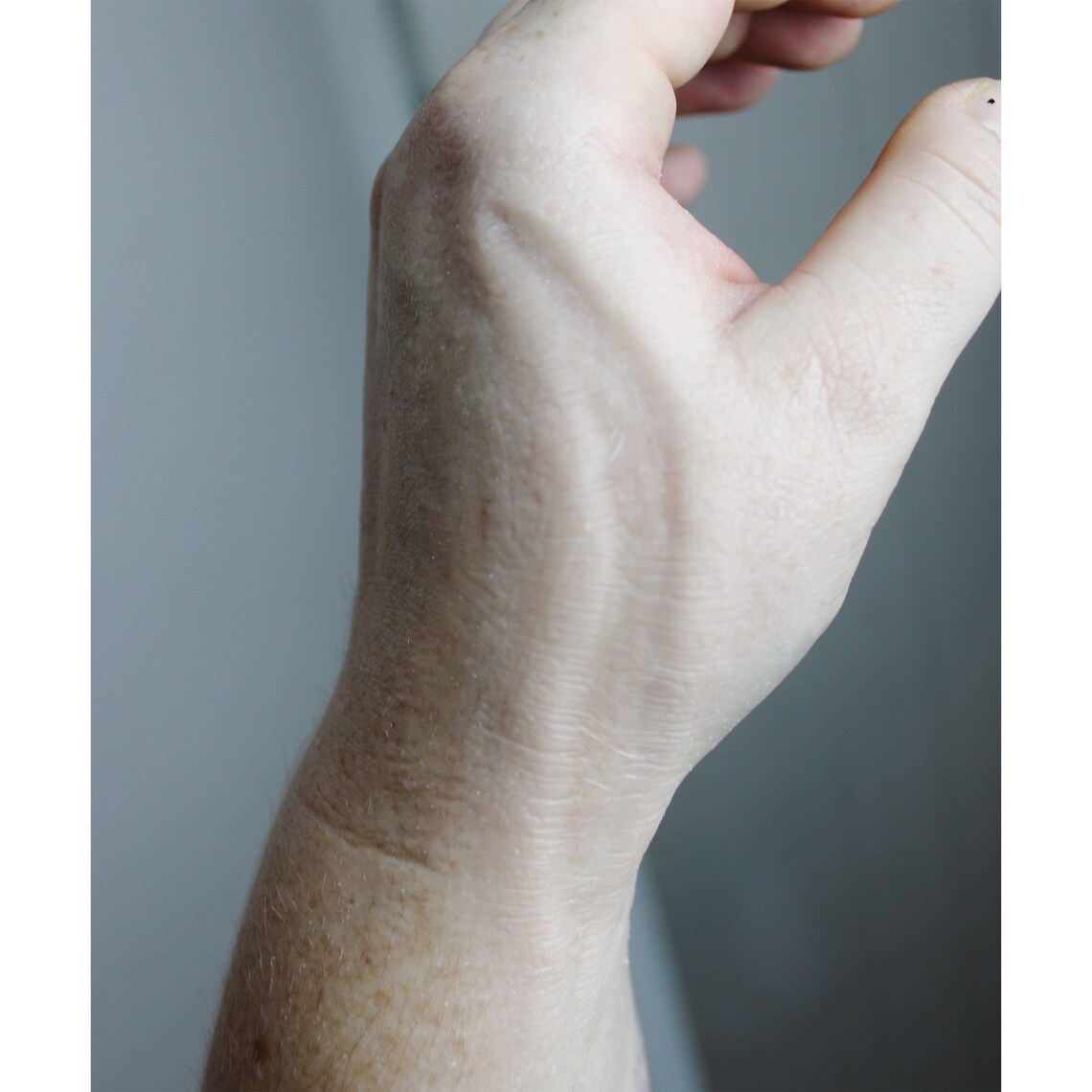 Medium Scar Prosthetic 1 // Encapsulated Silicone Appliance // Injury ...