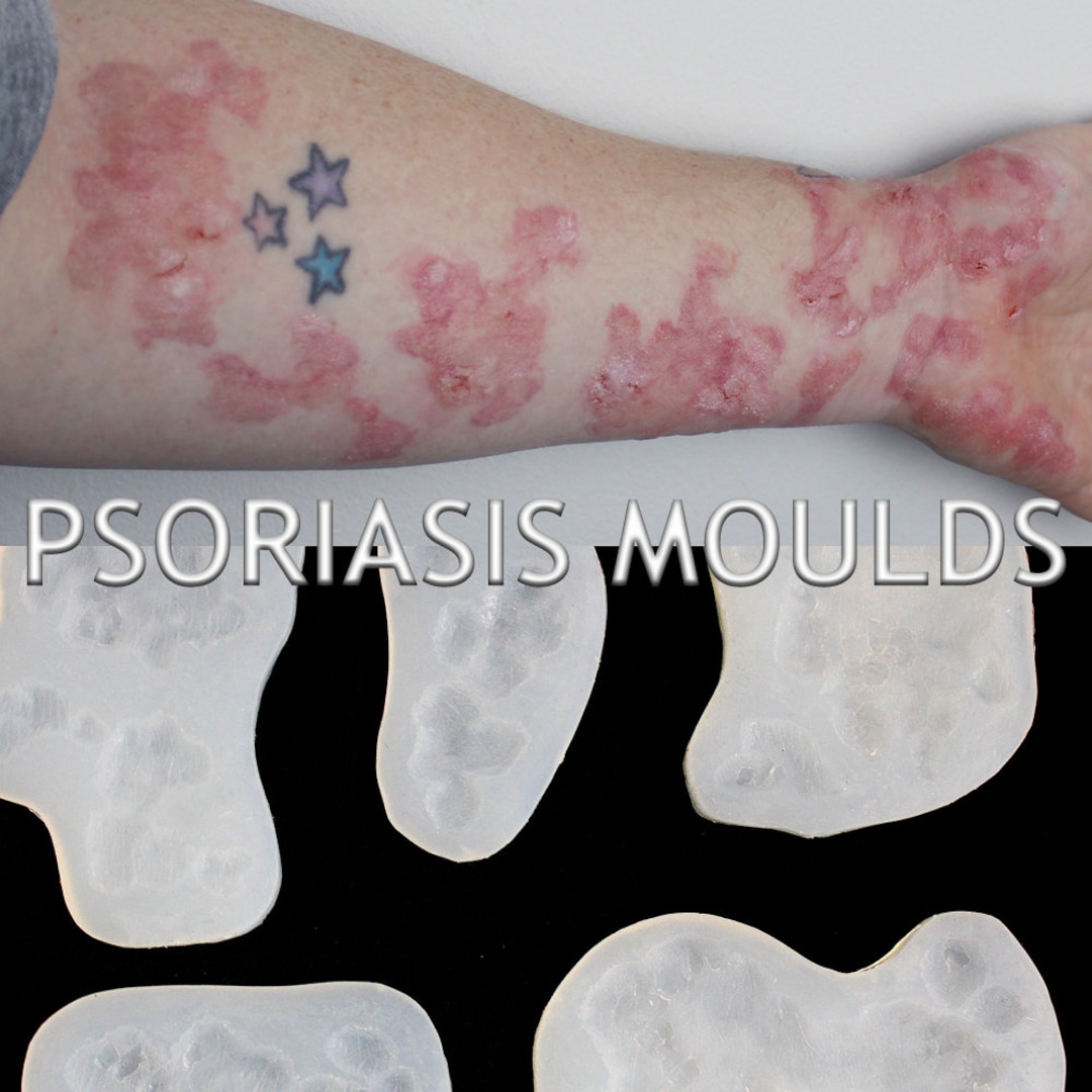 5 Psoriasis Silicone Bondo Moulds for Professional Makeup Artists to ...