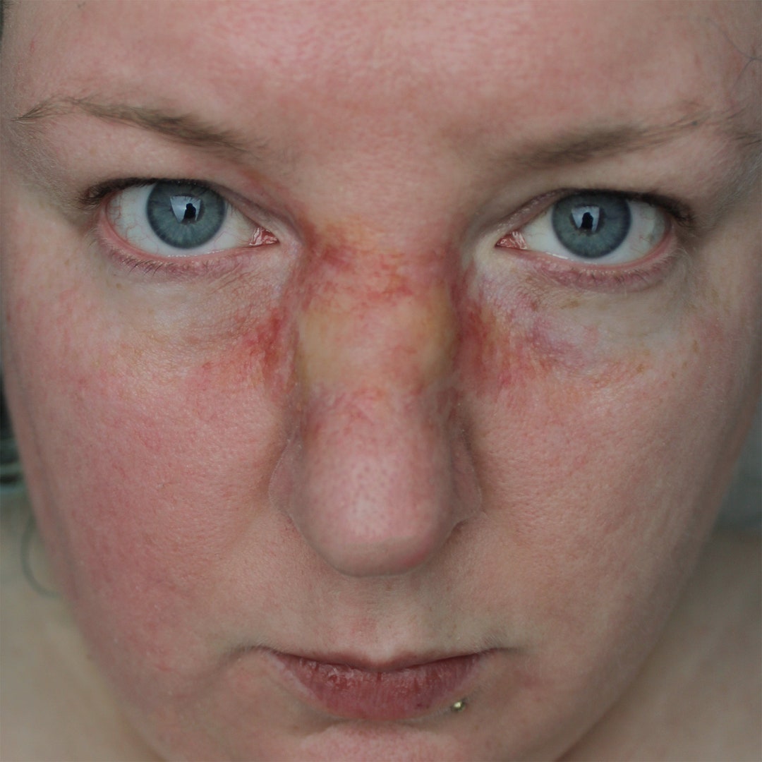 Broken Nose 1 Prosthetic // Encapsulated Silicone Appliance // Beaten ...