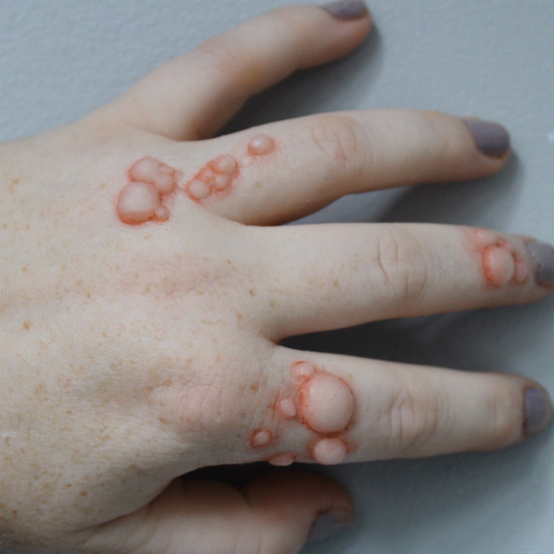 Small Boils Infection Prosthetics // Seven Encapsulated - Etsy