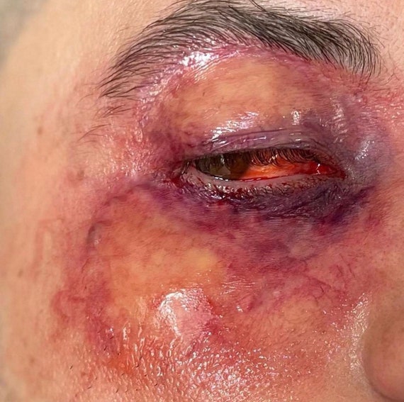 Black Eye Bruise Makeup