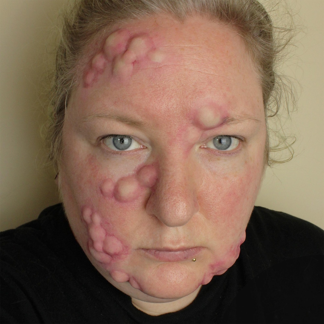 Medium Boils Silicone Prosthetics // Encapsulated Silicone Appliance ...