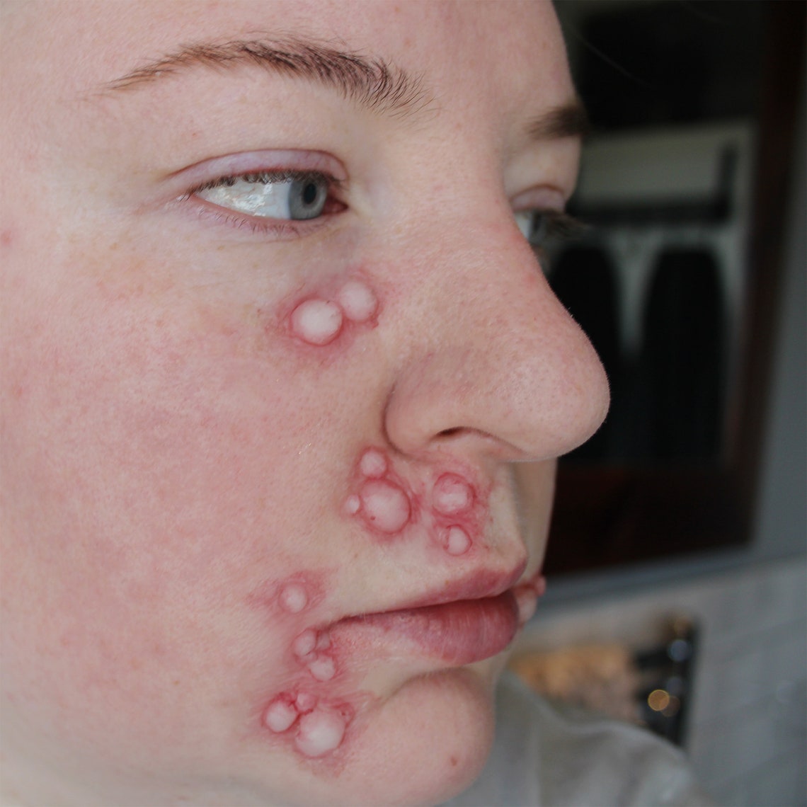 Small Boils Infection Prosthetics // Seven Encapsulated | Etsy