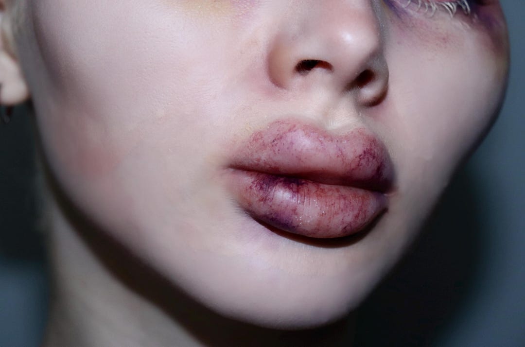 Plastic Surgery Botched Lips Prosthetic // Encapsulated Silicone ...