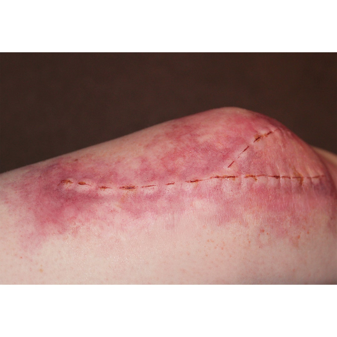 Suture Scar // Encapsulated Silicone Prosthetic // Scar Wound Healing ...