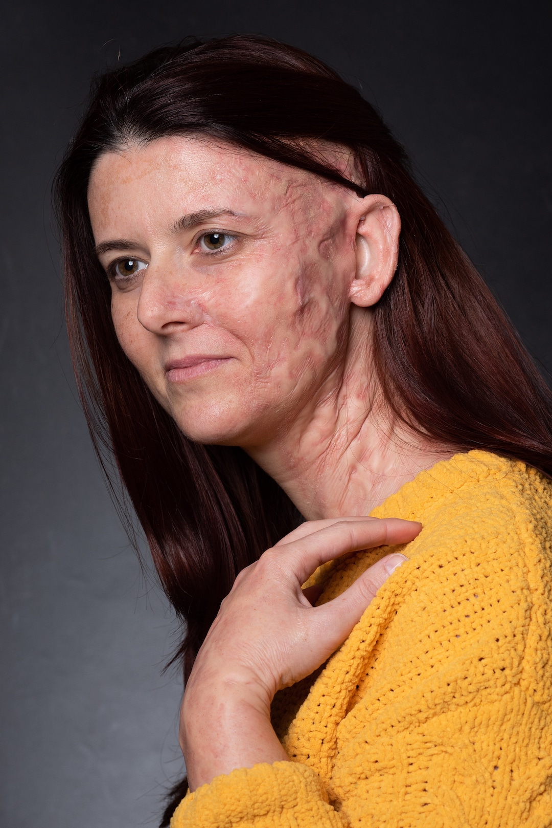 Set of Silicone Burn Scar Prosthetic Appliances // - Etsy Israel