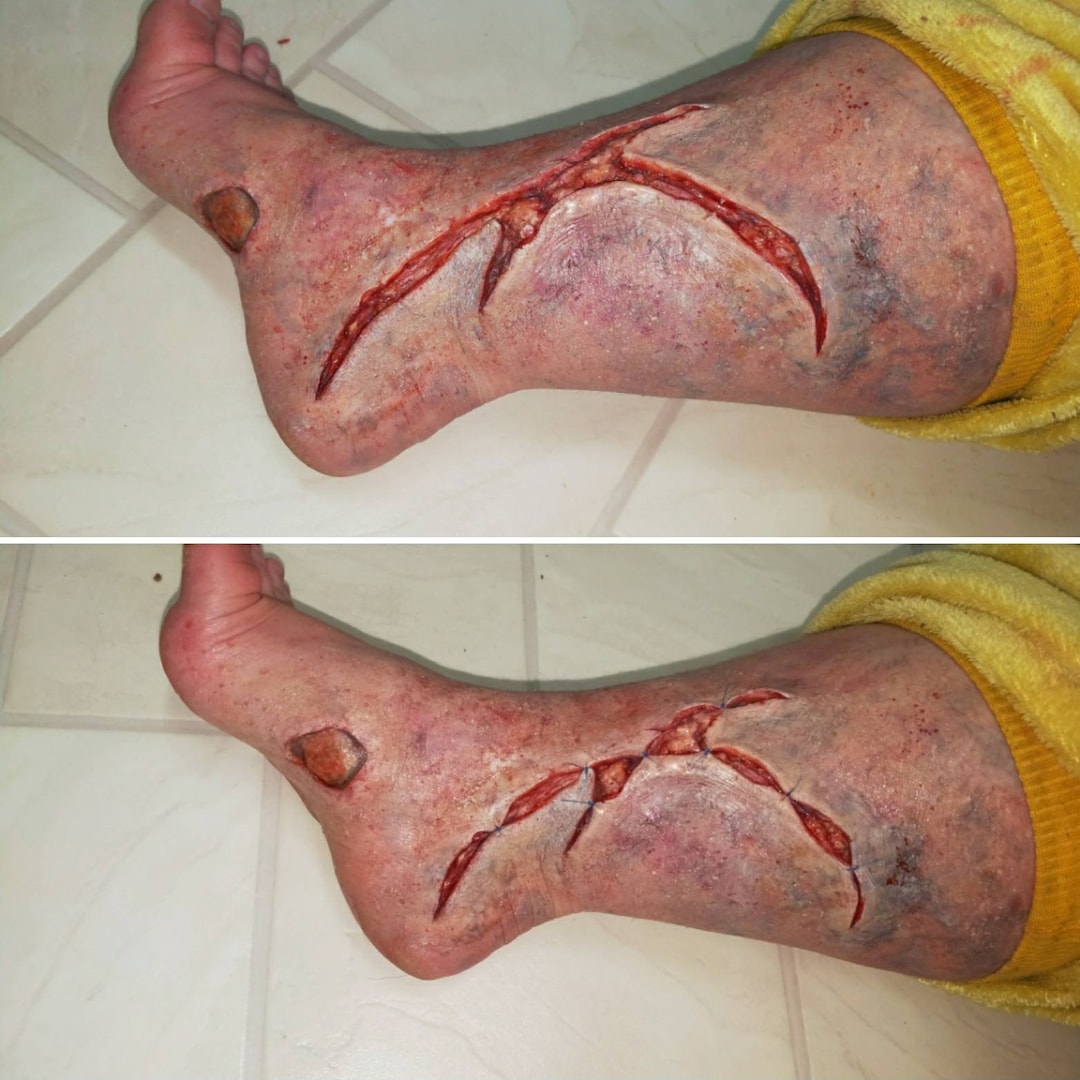 X Wound Encapsulated Silicone Prosthetic Appliance, Large Prosthetics ...