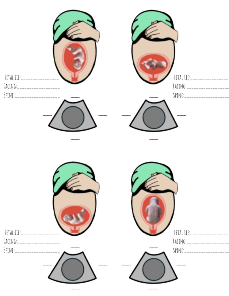 Ultrasound Study Guide: Fetal Lie / Fetal Situs - Etsy