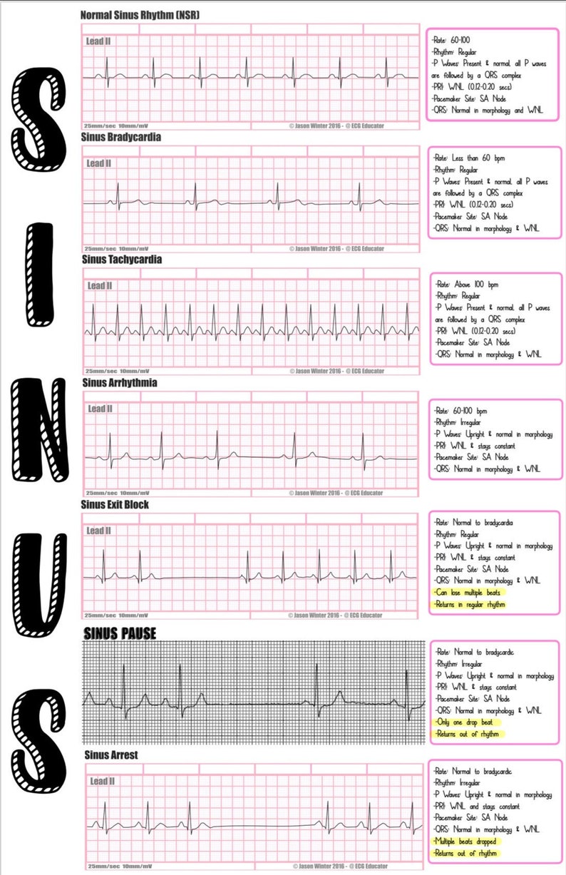 EKG Need to Knows/ Nursing/ EMT- Paramedic/ Cardiology - Etsy