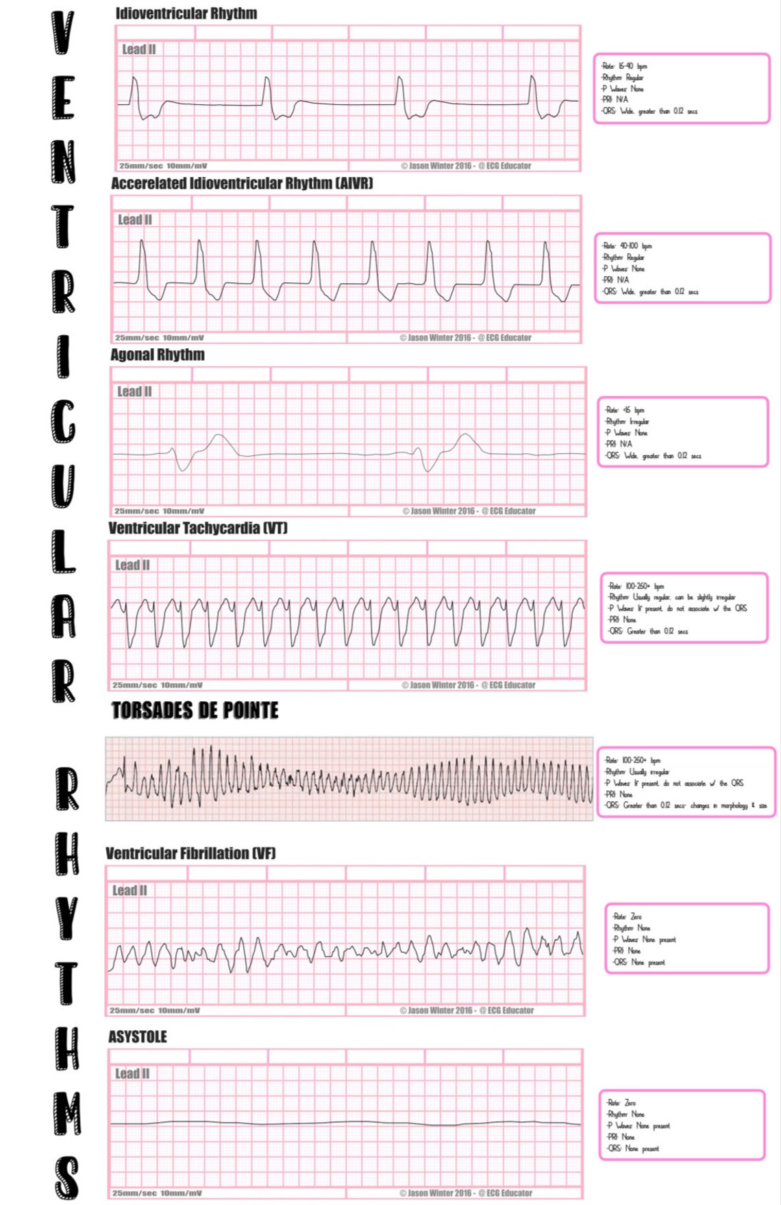 EKG Need to Knows/ Nursing/ EMT- Paramedic/ Cardiology - Etsy Canada