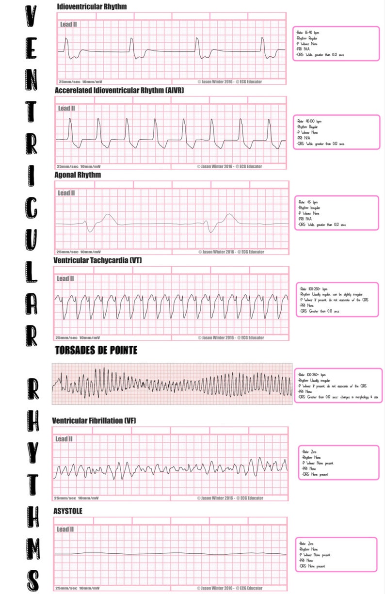 EKG Need to Knows/ Nursing/ EMT- Paramedic/ Cardiology - Etsy