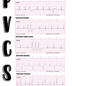 EKG Need to Knows/ Nursing/ EMT- Paramedic/ Cardiology - Etsy