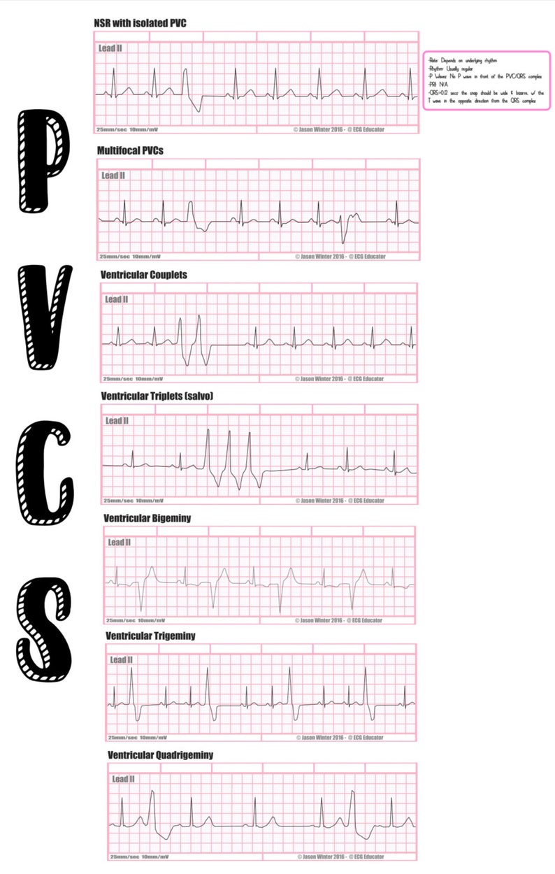 EKG Need to Knows/ Nursing/ EMT- Paramedic/ Cardiology - Etsy