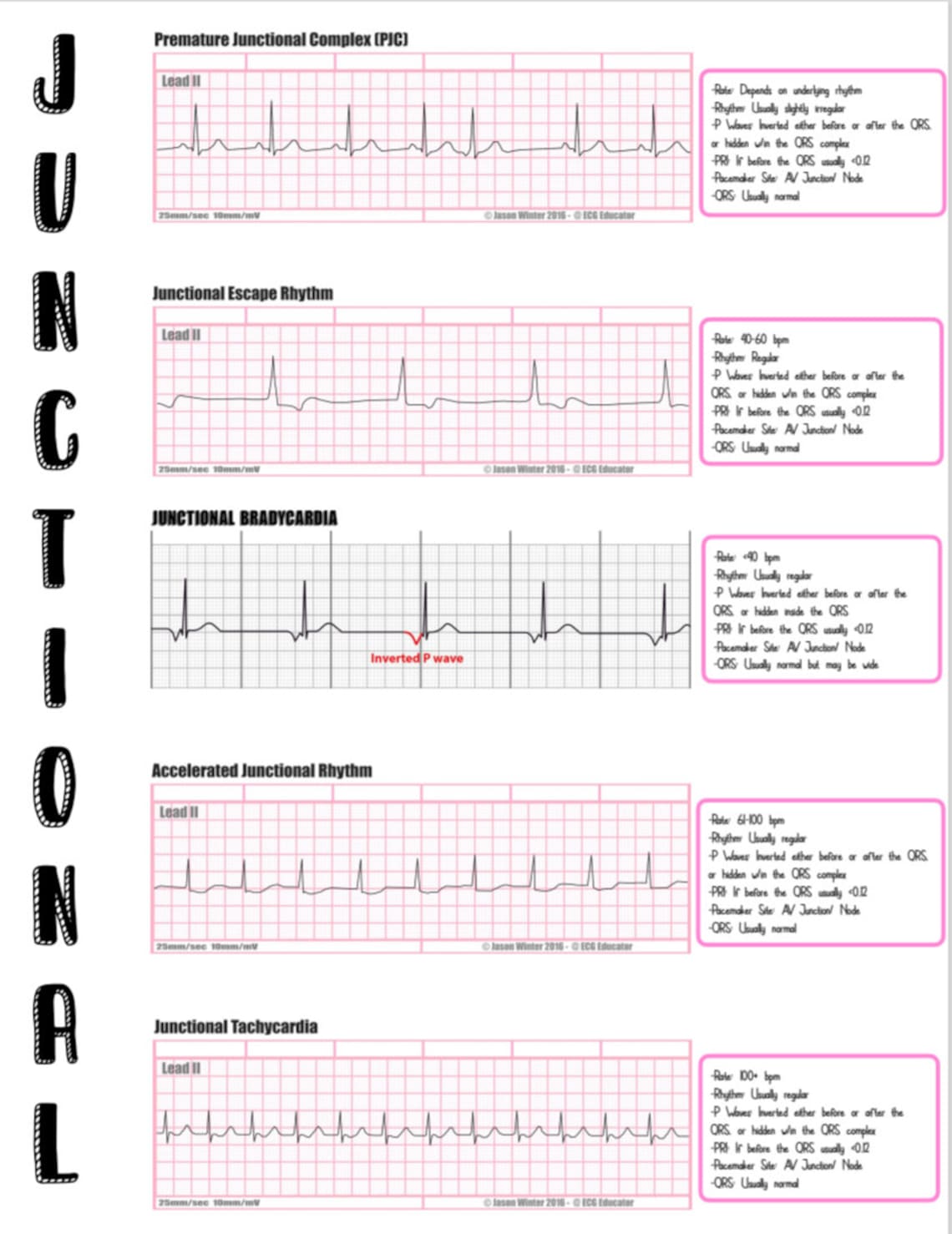 EKG Need to Knows/ Nursing/ EMT- Paramedic/ Cardiology - Etsy
