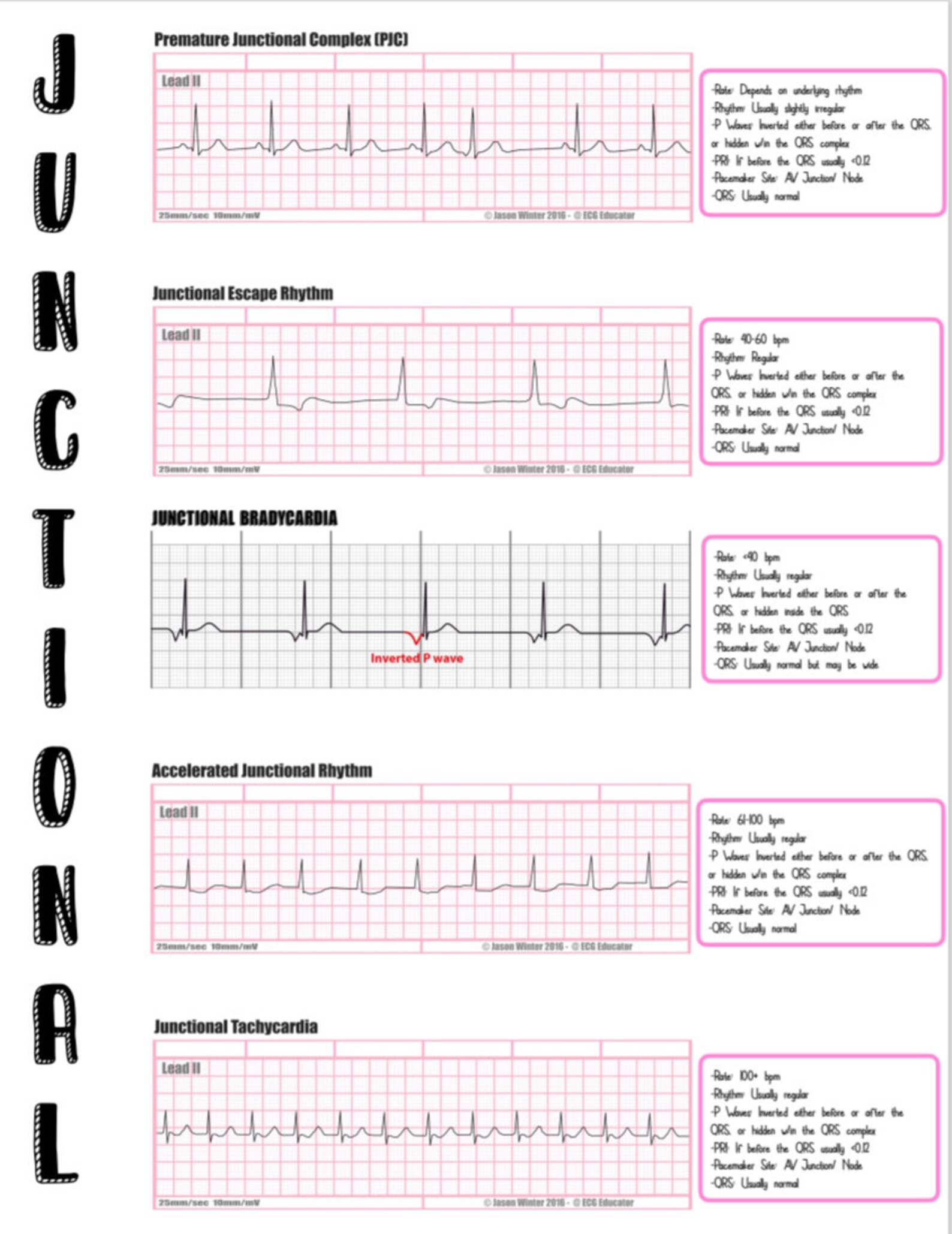 EKG Need to Knows/ Nursing/ EMT- Paramedic/ Cardiology - Etsy