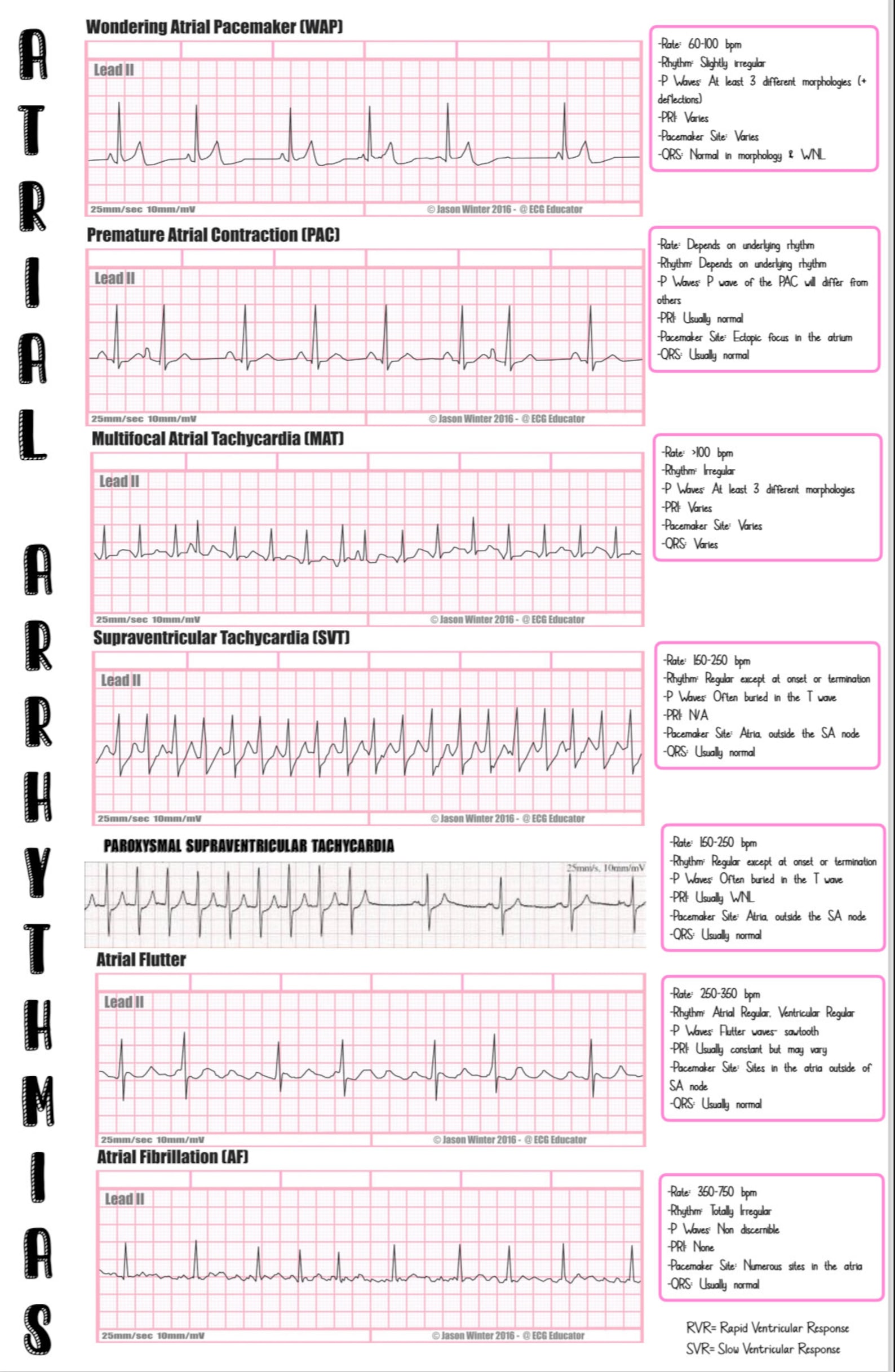 EKG Need to Knows/ Nursing/ EMT- Paramedic/ Cardiology - Etsy