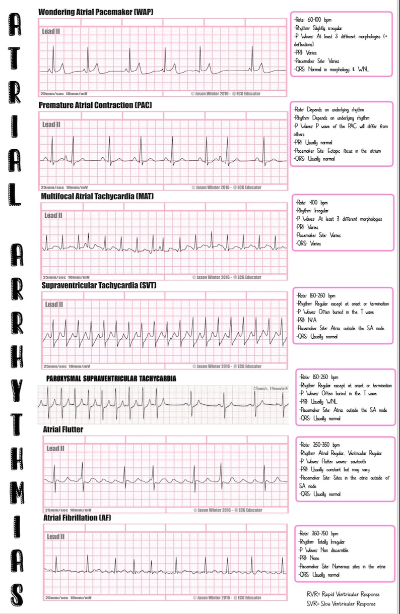 EKG Need to Knows/ Nursing/ EMT- Paramedic/ Cardiology - Etsy