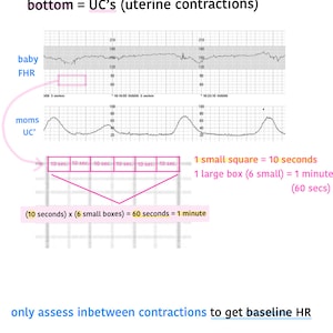 Fetal Heart Rate Interpretation, Fetal Heart Strips, Labor and Delivery ...