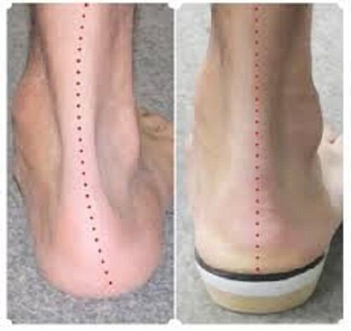 Two Pair of Arch Aid Arch Supports Orthotics Orthotic Custom Orthotics ...