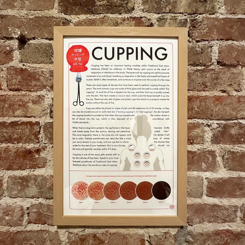 Cupping 11x17 Digital Download - Etsy