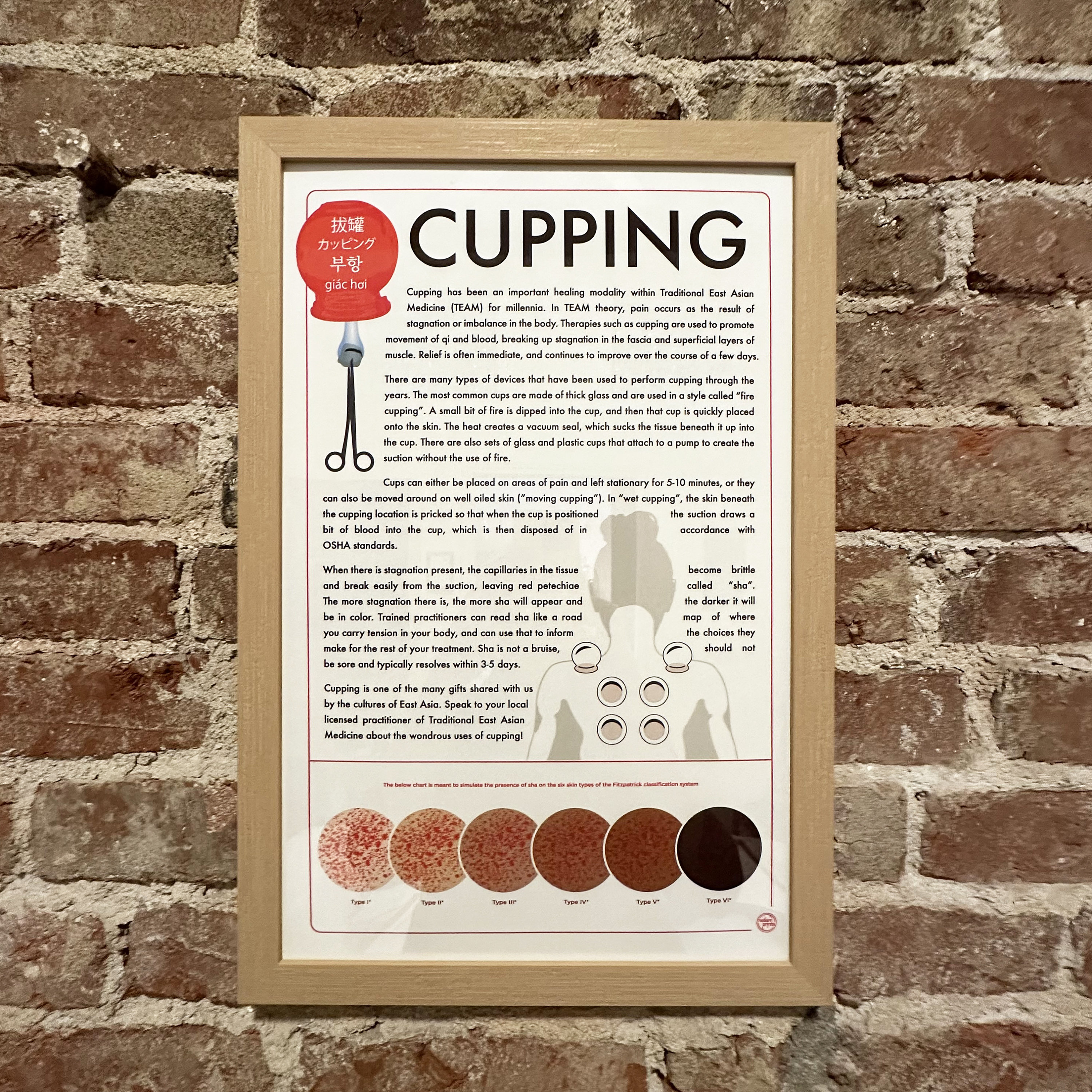 Cupping 11x17 Digital Download - Etsy