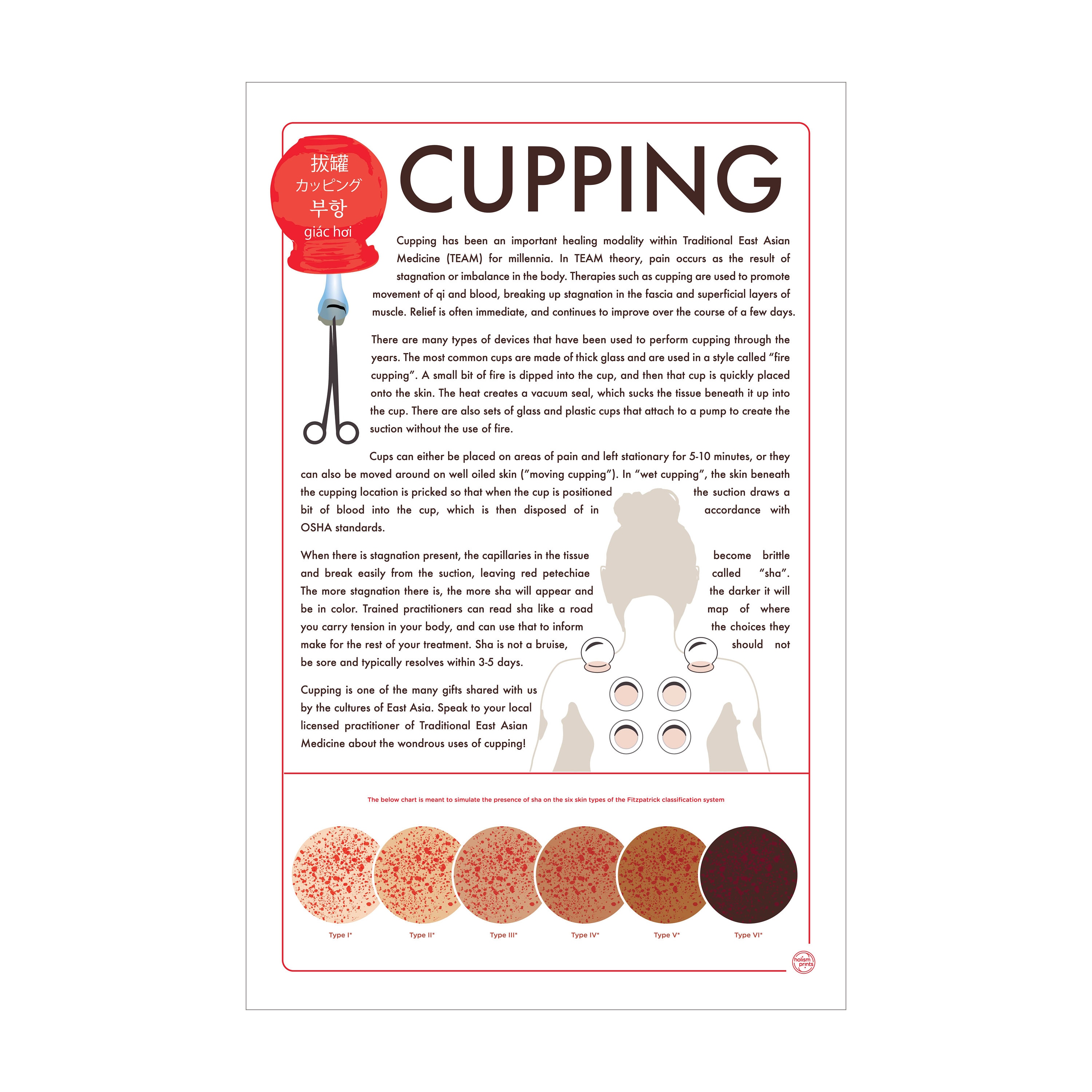 Cupping 11x17 Digital Download - Etsy