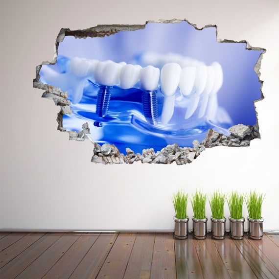 Dental Implant Wall Decal Sticker Mural Poster Print Art | Etsy