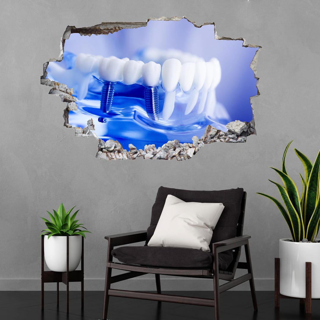 Dental Implant Wall Decal Sticker Mural Poster Print Art Dental Care ...
