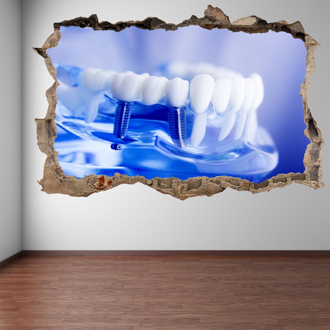 Dental Implant Teeth Wall Decal Sticker Mural Poster Print Art Dental ...